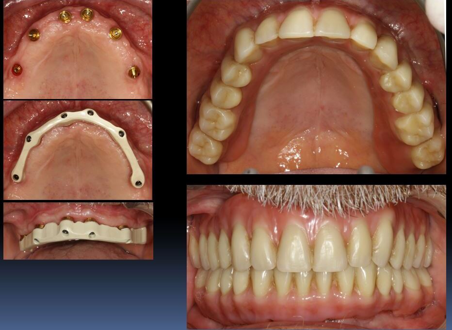 Bridge complet sur implant Haute Loire Le Chambon sur Lignon Monistrol ...