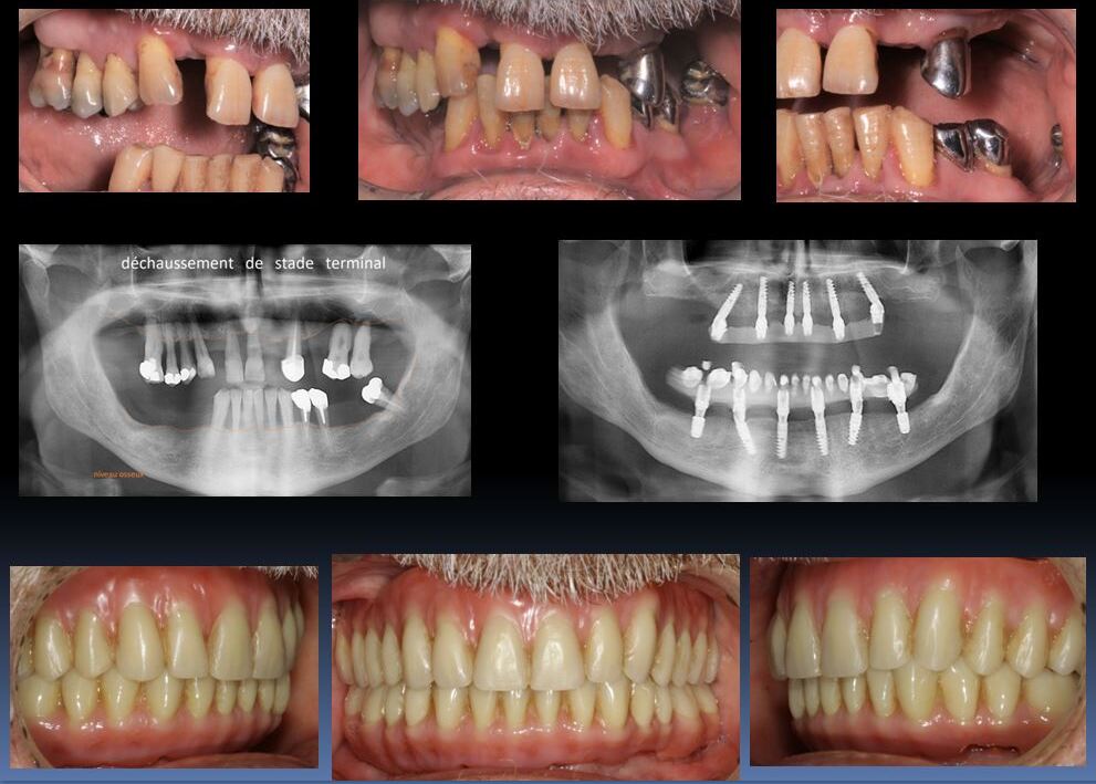 Bridge complet sur implant Haute Loire Le Chambon sur Lignon Monistrol ...